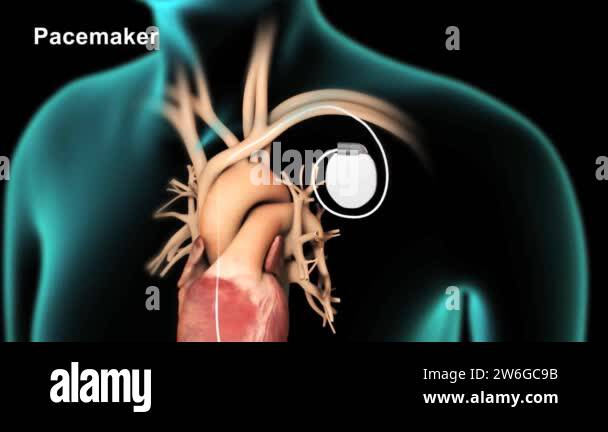Pacemakers are installed in angio catheter laboratories Stock Video ...