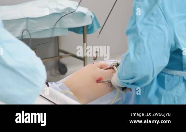 Laparoscopic surgery in hospital. Modern medical equipment in operating ...