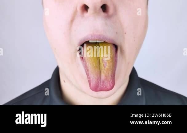 The man has a yellow tongue. Painful yellow coating on the mucous ...