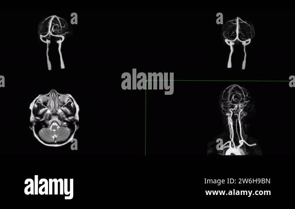 MRV Brain or magnetic resonance venography of The Brain 3D mip view ...