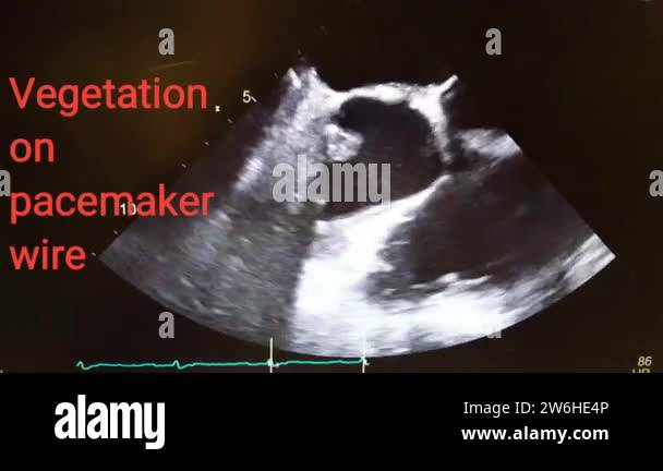 Chamber pacemaker Stock Videos & Footage - HD and 4K Video Clips - Alamy