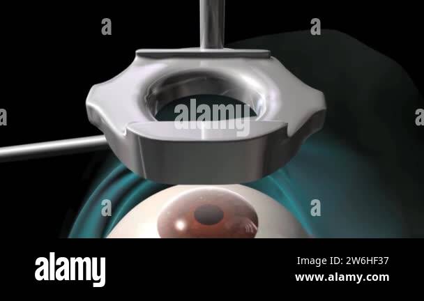 Cataract lens implant Stock Videos & Footage - HD and 4K Video Clips ...