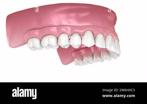 Maxillary prosthesis All on 4 system supported by implants. Medically ...