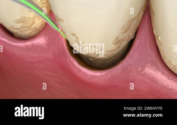 Thin teeth Stock Videos & Footage - HD and 4K Video Clips - Alamy