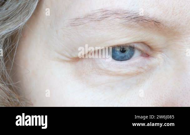 middle aged female's eye with drooping eyelid. Ptosis is a drooping of ...