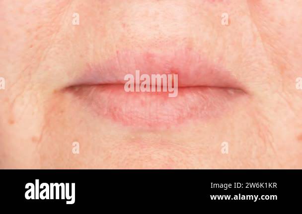Herpes simplex rash skin Stock Videos & Footage - HD and 4K Video Clips ...