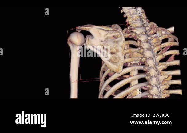 CT scan 3D rendering of Left shoulder showing fracture head of humerus ...