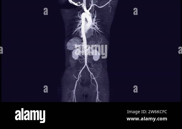 CTA Whole aorta 3D MIP ,Angiography MIP technique turn around on the ...
