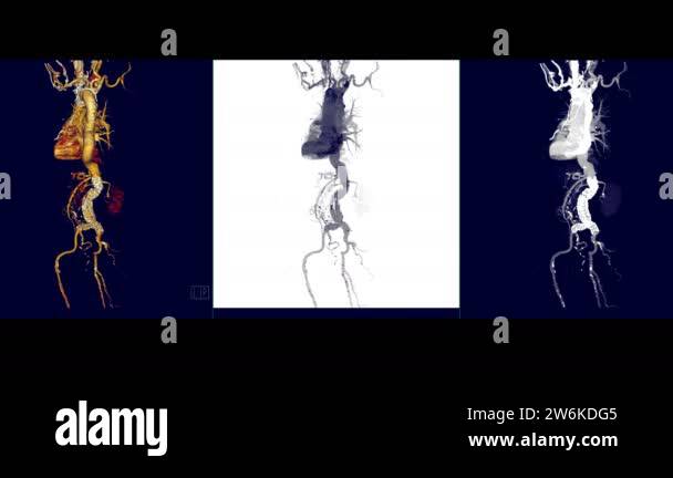 CTA Whole aorta 3D MIP ,Angiography MIP technique turn around on the ...