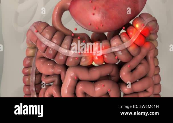 Failing and injured stomach in . Cancer, tumor tissue problem ...