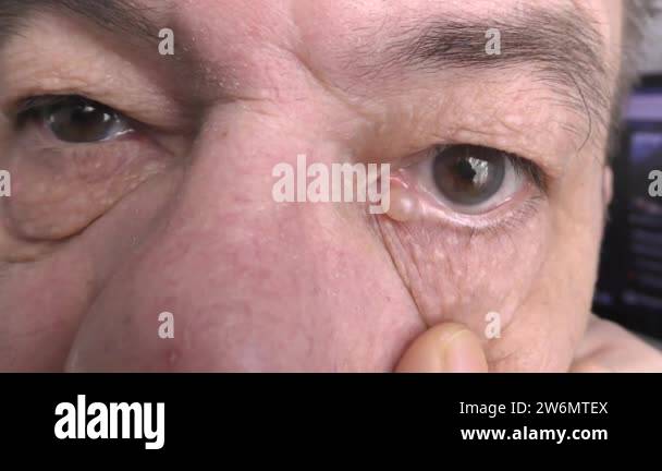 Apocrine hydrocystoma of the eyelid. This is a benign Moll gland cyst ...
