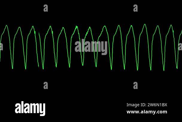 Ventricular tachycardia vt Stock Videos & Footage - HD and 4K Video ...