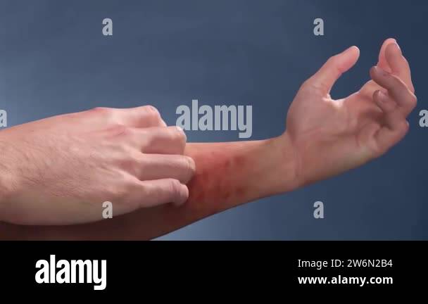 Allergic reaction and itching cause sores on the arm Stock Video ...