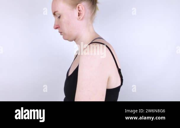 Kyphosis. The woman suffers from a curvature of the spine in the upper ...