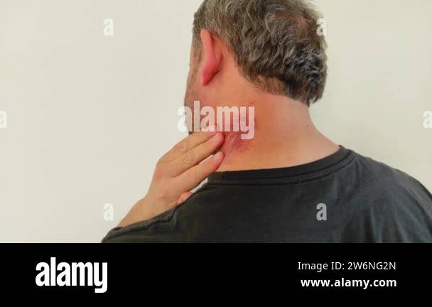 A man who is red and bruised after muscle stiffness in the neck area ...