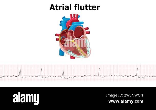 ecg shows atrial flutter arrhythmia with heart animation Stock Video ...