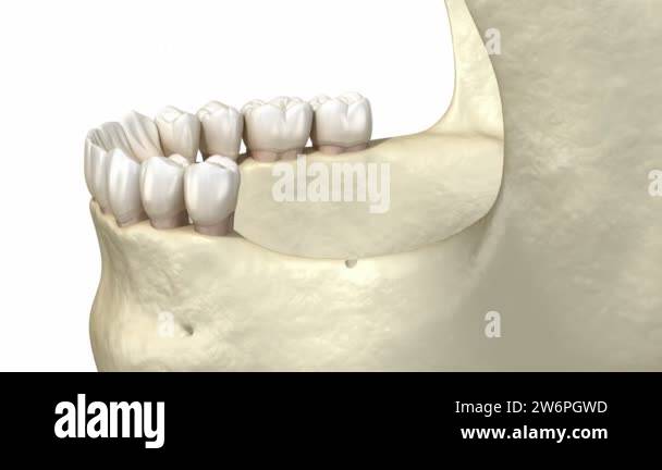 Cleavage of the alveolar ridge, augmentation, implantation. Dental ...