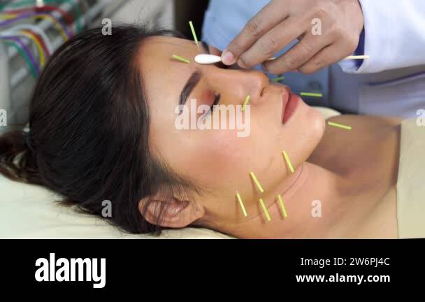Young woman undergoing acupuncture Stock Videos & Footage - HD and 4K ...