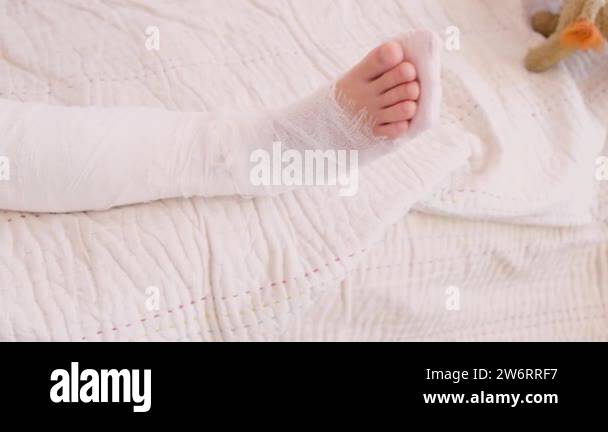 broken leg. Close-up of the cast on the feet. exercises to repair and ...
