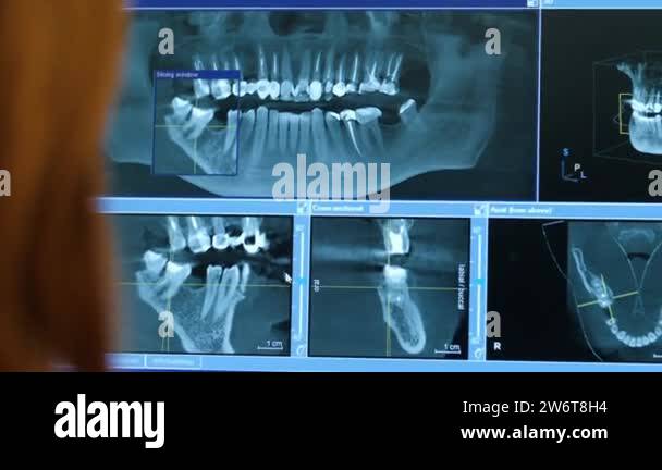 View rays jaw teeth Stock Videos & Footage - HD and 4K Video Clips - Alamy
