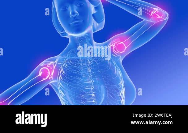 Anatomical 3d animation of a woman's figure graphically showing joint ...