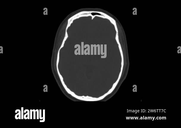 Brain neurons ct scan Stock Videos & Footage - HD and 4K Video Clips ...