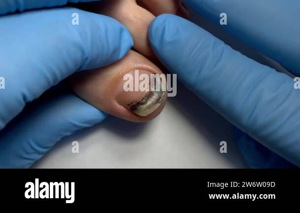 Hematoma under the nail Stock Video Footage - Alamy