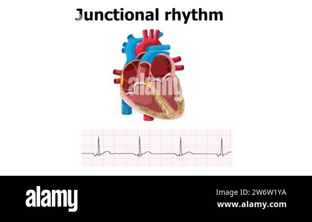 ecg shows junctional rhythm arrhythmia with heart animation Stock Video ...