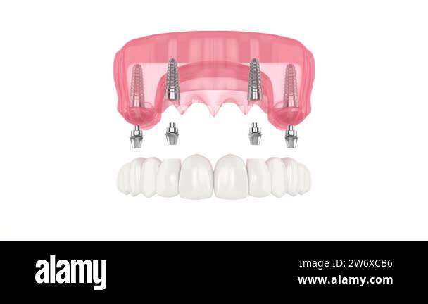 Mandibular prosthesis all on 4system supported by implants Stock Video ...