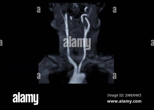 Carotid stenosis Stock Videos & Footage - HD and 4K Video Clips - Alamy
