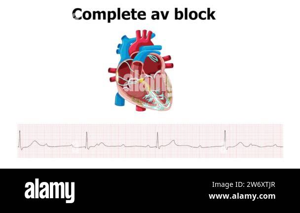 ecg shows complete av block (3rd degree av block) with heart animation Stock Video Footage - Alamy