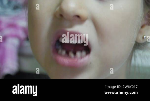 Losing Tooth Wobbly Tooth Kid's Mouth Close Up Girl's Face Close Up ...