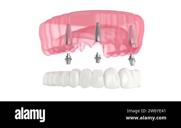 Mandibular prosthesis all on 4system supported by implants Stock Video ...