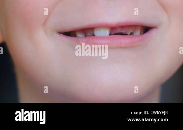 little child boy patient open mouth showing caries teeth decay. Dental ...