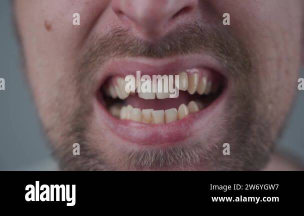 Dental displacement. Male mouth with crooked teeth and malocclusion ...