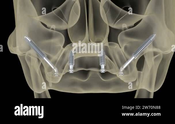 Maxillary prosthesis supported by zygomatic implants. Medically ...