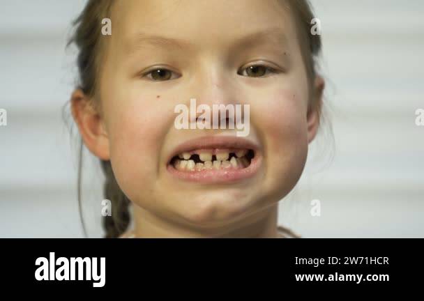 Girl of 7-8 years old shows her mouth with missing milk teeth. Loss of ...
