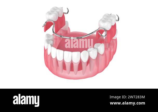 Removable partial denture lower teeth Stock Videos & Footage - HD and ...