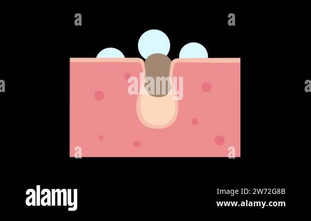 Cleaning clogged pores process 2D animation on transparent background ...