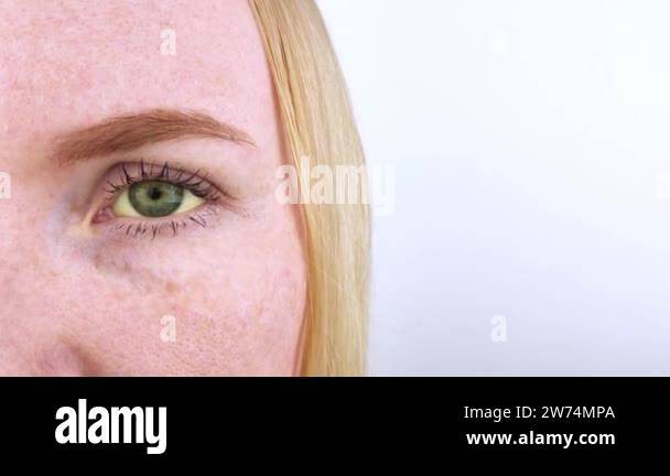 The yellow color of the woman eye. Symptom of jaundice, hepatitis or ...