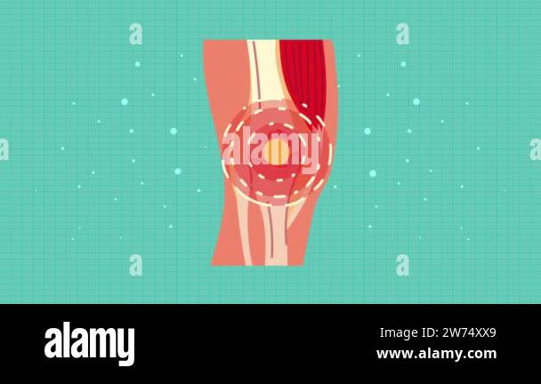 knee pain rheumatology disease animation Stock Video Footage - Alamy