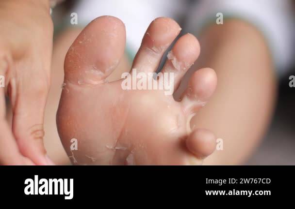 female feet during an acid peeling procedure.skin renewal and ...