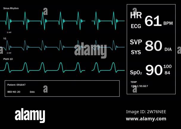 Looped: Patient monitor displays vital signs ECG electrocardiogram EKG ...