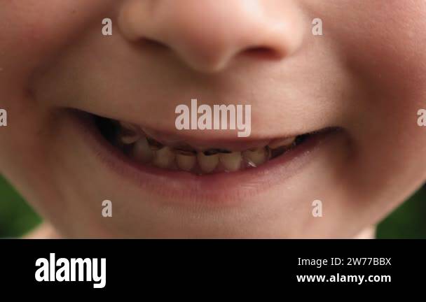 Child showing missing teeth. Smiling little boy. Close up of boy's lips ...
