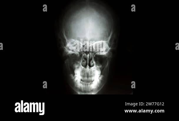 Zoom-in X-ray of a human skull, human bones. 4K Stock Video Footage - Alamy