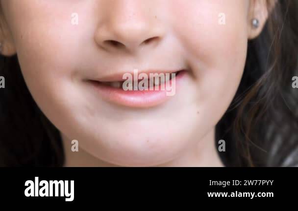 Little child girl patient open mouth showing caries teeth decay. Dental ...