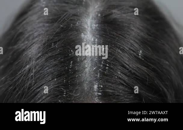 Diseases of the scalp Stock Videos & Footage - HD and 4K Video Clips ...