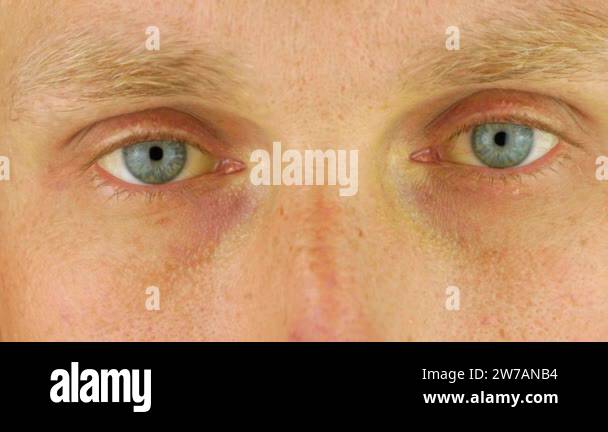 Mens eyes obstructive Jaundice yellowish. Real people liver dysfunction ...