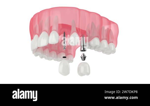 Upper jaw with two types of dental implants placement over white ...