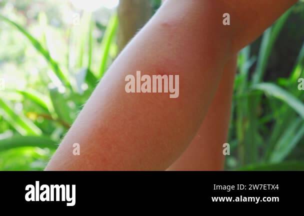 Red bite mark on the leg. Itching and inflammation. Scratch the wound ...